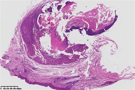 眼角包块，钙化上皮瘤？ 华夏病理网论坛