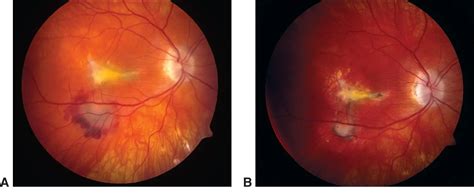 Choroidal Neovascularization American Academy Of Ophthalmology
