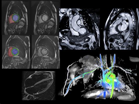 Cardiac Mri A Powerful Tool For Heart Health
