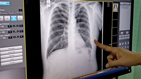 Symptoms And Diagnosis Of Copd