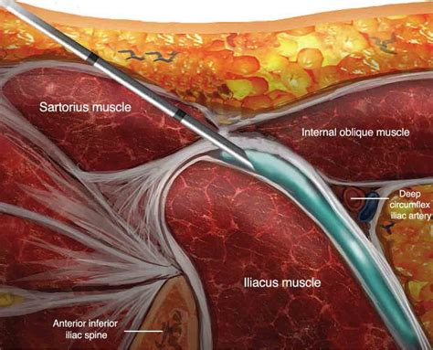 Ultrasound Guided Fascia Iliaca Nerve Block Nysora