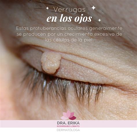 Dra 👁👉las Verrugas En Los Ojos Son Pequeñas Protuberancias Que