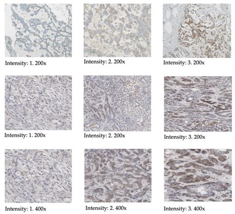 Illustration Of Scoring Of The Sstr2 Intensity According To The Her2 Download Scientific