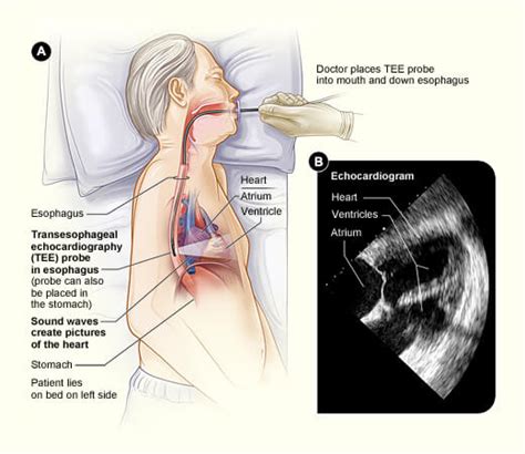 Transesophageal Echocardiogram Tee Cardiovascular Consultants Ltd