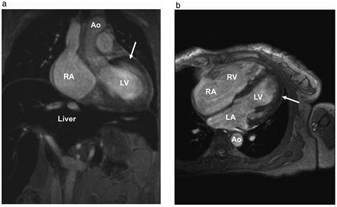 Cardiac Hemochromatosis International Journal Of Cardiology