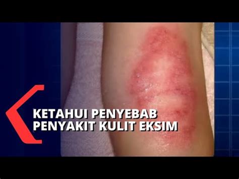 Dermatitis Penyebab Jenis Gejala Diagnosis Metode Pengobatan