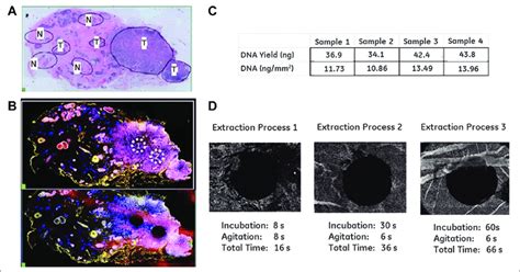 A Breast Invasive Ductal Carcinoma Formalin Fixed Paraffin Embedded Download Scientific