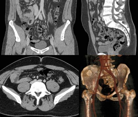 Ct Scans In All Planes With 3d Rendering Demonstrate Severe Compression Download Scientific