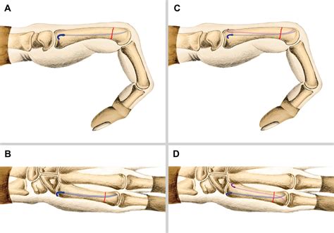 Ortho Globe Metacarpal Fractures