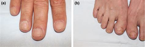 Alopecia Areata Nails