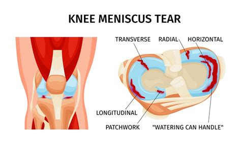 Meniscus Tear Symptoms Causes And Treatment