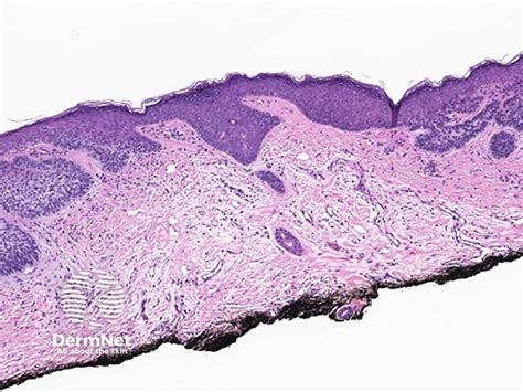 Basal Cell Carcinoma Histopathology Image