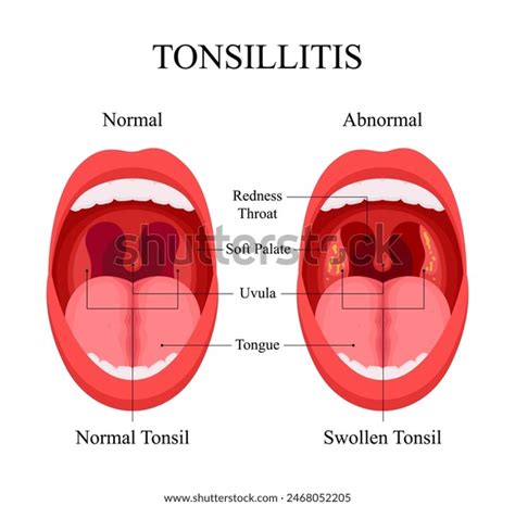 Diagramme Des Causes De Tonsillitis Tonsils Image Vectorielle De
