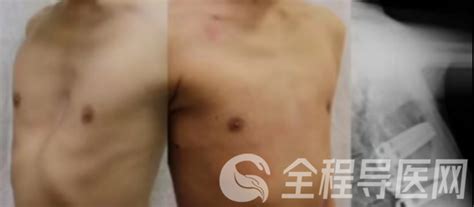 徐州市儿童医院心胸外科张冲儿童漏斗胸与缺钙无关微创NUSS治疗 主页