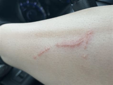Yesterday I Noticed This Itchy Line Of Bug Bites Theyre Red Raised Bumps In A Line Anyone