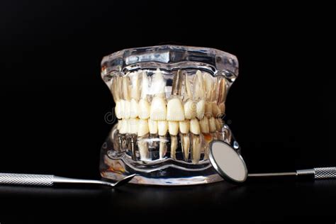 Dental Jaw Model Over Black Background Dentist Dental Prosthetic Teeth Gums Roots Close Up