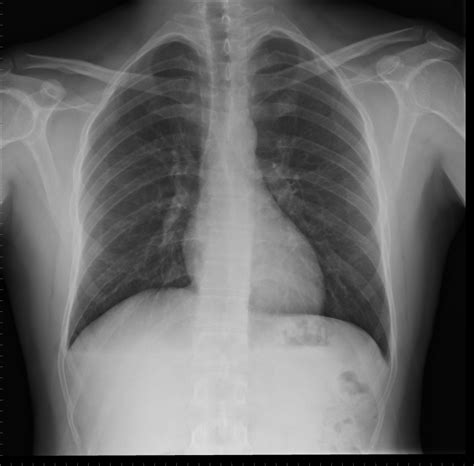 Manubriosternal Dislocation Eurorad