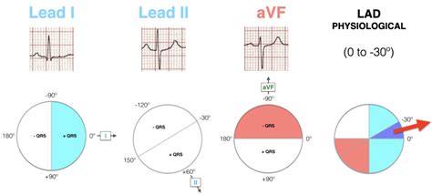 Ecg Axis Interpretation • Litfl • Ecg Library Basics