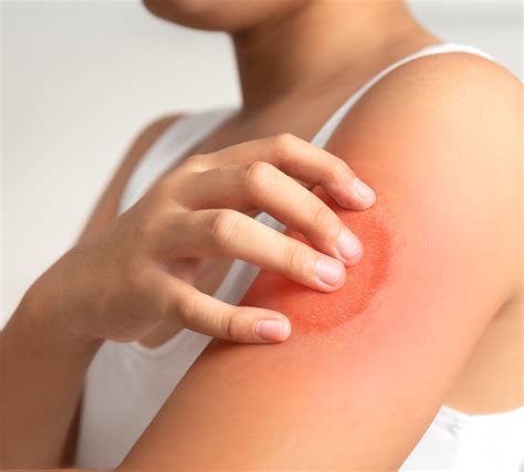 Акримиколь крем 2 — противогрибковое средство от грибковых инфекций кожи