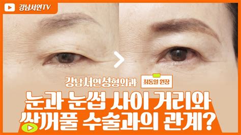 성형탐구 I 쌍꺼풀 수술을 하면 눈과 눈썹 사이가 가까워진다 눈썹에 대한 오해 Youtube