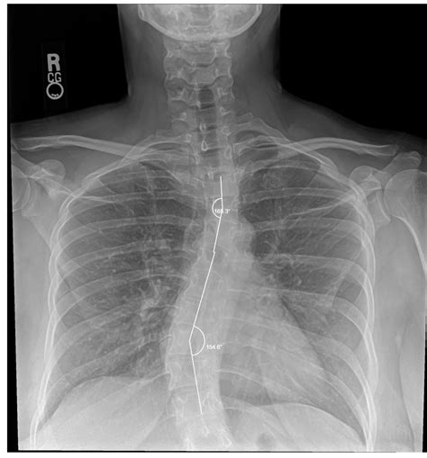 No Cobb Angles Rscoliosis