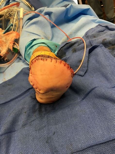 David Armstrong On Linkedin Functional Outcomes Of Transmetatarsal