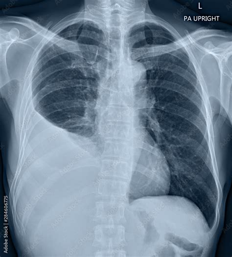 Film X Ray Chest Moderate Loculated Right Pleural Effusion Stock Illustration Adobe Stock