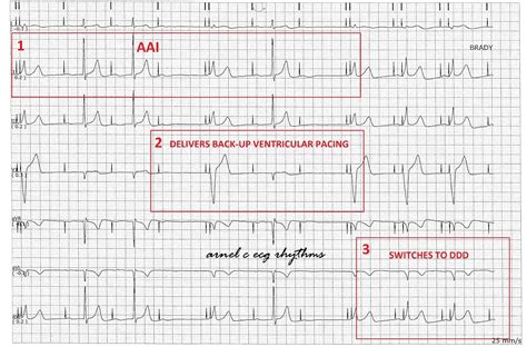 Ecg Rhythms Managed Ventricular Pacing