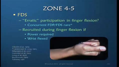 The Zones Of The Hand Flexor Refer To Anatomical Areas Of The Hand Where Flexor Tendons Are