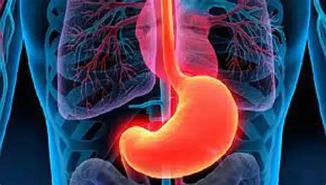 Plantas Medicinales Ayudarán A Combatir La Gastritis 2025 Elyex