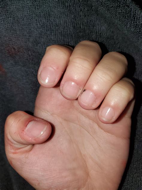 After 19 Years Of Chronic Nail Biting Its Starting To Look Better