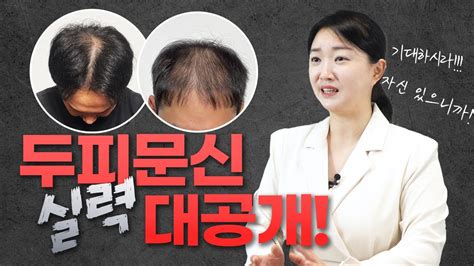 두피문신 숱보강 할까 삭발시술 할까 이 영상 보고 결정하세요 [도트락 청주 탈모 모발] Youtube