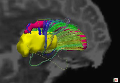 High Angular Resolution Diffusion Imaging Versus Diffusion Tensor Imaging Structural
