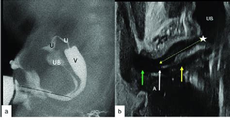 Ambiguous Genitalia Ultrasound Ambiguous Genitalia Ultrasound