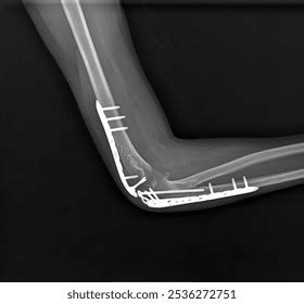 Best Elbow Fracture Fixation Royalty Free Images Stock Photos Pictures Shutterstock