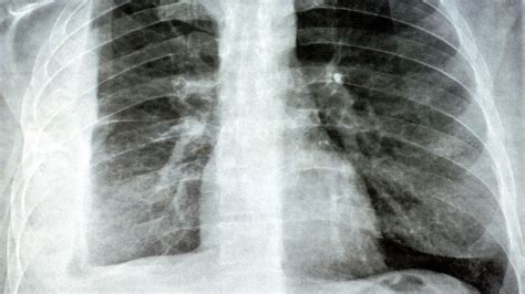 Study Backs Recommended Antibiotic Approach For Aspiration Pneumonia