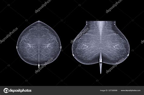 Basic Position Ray Digital Mammogram Both Side Name View Mlo — Stock