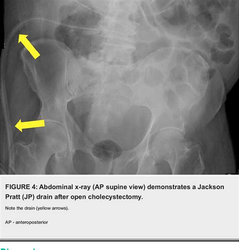 Figure 2 From Occult Perforated Gangrenous Gallbladder Found On