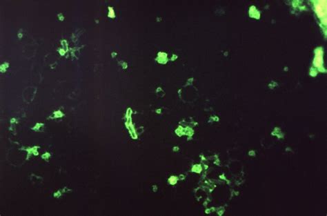 Free Picture Histopathology Lymph Node Fatal Human Plague