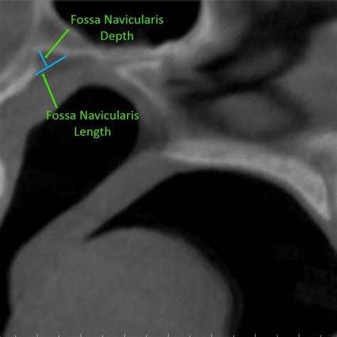 Figures Figure 1 A Depth And Length Measurements Of Fossa Navicularis