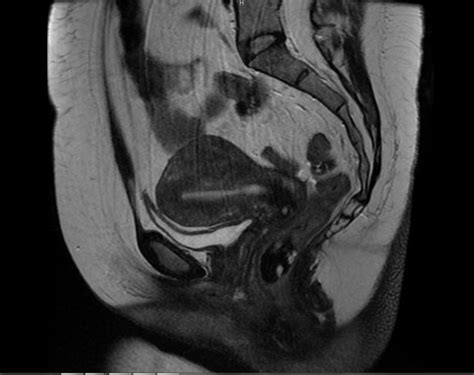 Mri Anatomy Female Pelvis At Martin Huey Blog