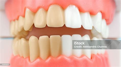 미백 전후에 깨끗하고 더러운 치아 치과 개념 사진입니다 클로즈업 개별 치아 트레이 교정 치과 테마 거울에 대한 스톡 사진 및 기타 이미지 Istock