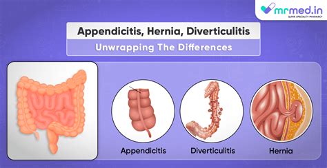 An Insight Of Appendicitis Hernia Diverticulitis Mrmed