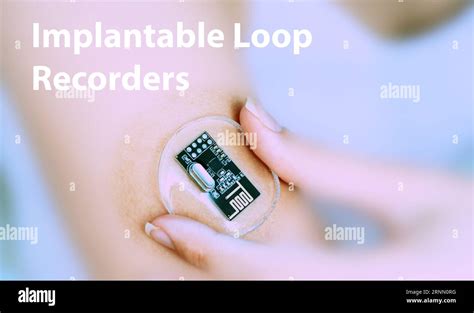 Implantable Loop Recorders Small Devices Placed Under The Skin To Record And Monitor Heart