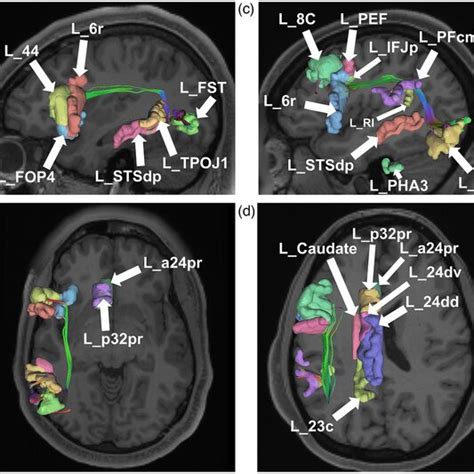 Tractographic Model Of Areas Fundus Of The Superior Temporal Sulcus A
