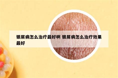 银屑病怎么治疗最好啊 银屑病怎么治疗效果最好 东方皮肤网