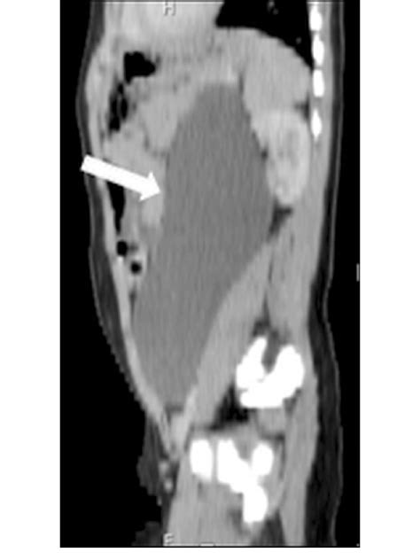 Mesothelial Cyst In A 8 Year Old Girl Sagittal Ct Image Shows An