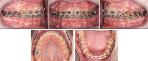 The Patients Intraoral Photographs Taken During Orthodontic Finishing Download Scientific