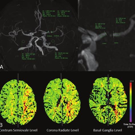 Color Coded Perfusion Parameter Maps Show The Degree Of Cerebral Download Scientific Diagram
