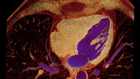 Photon Counting L Philips Healthcare Photon Counting L Philips Healthcare